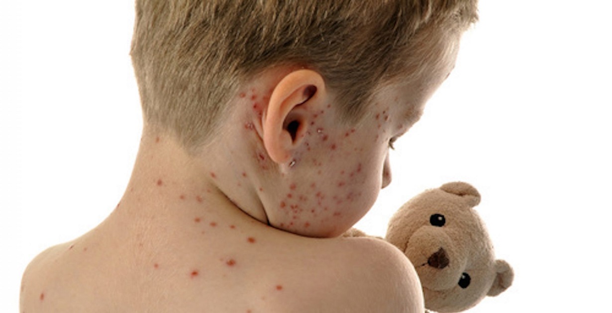 Morbillo, decorso e complicazioni. Ecco come riconoscere i sintomi.
